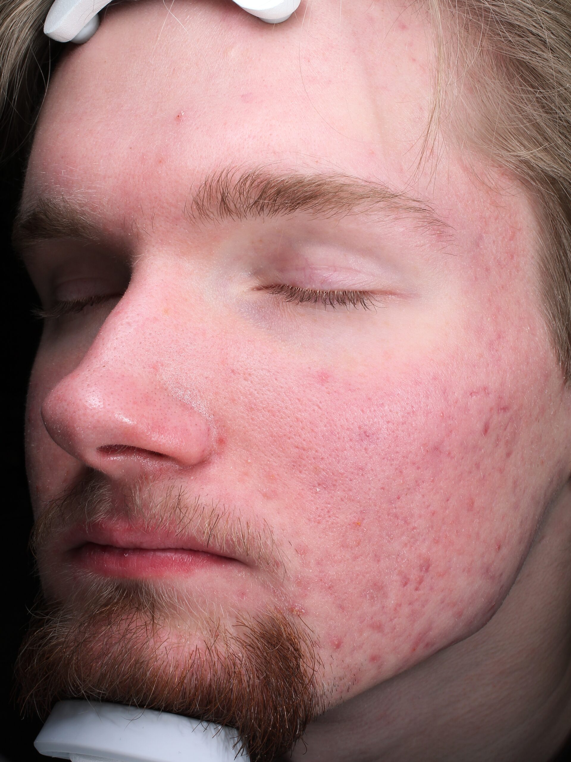Voor en na resultaten van behandelingen | Skin Kliniek