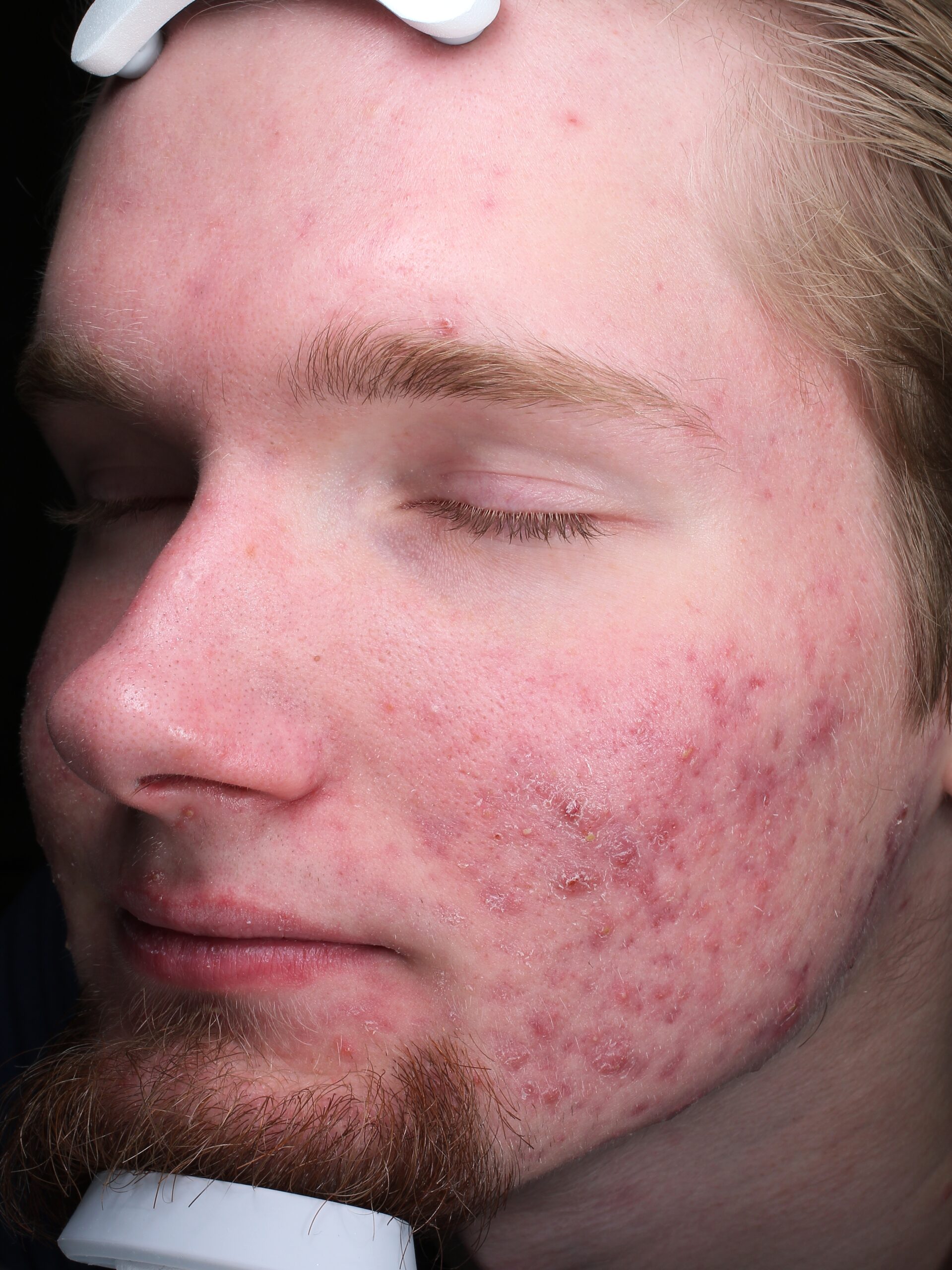 Voor en na resultaten van behandelingen | Skin Kliniek
